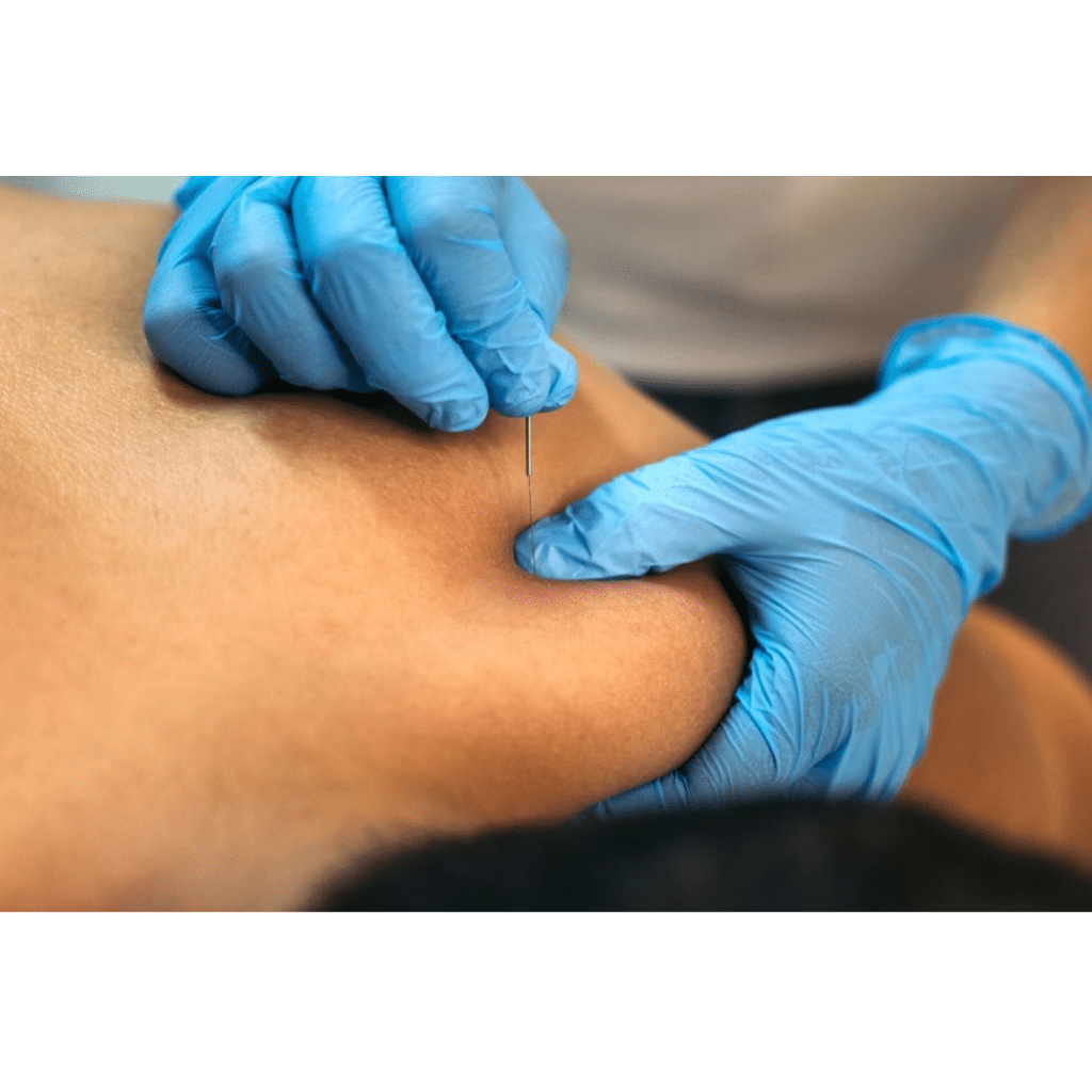 Punción seca en tendinitis: solución poderosa y efectiva